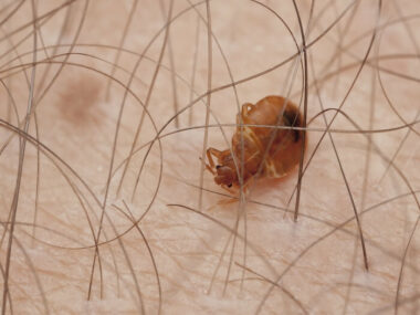Can Bed Bugs Live In Your Hair? How To Get Them Out