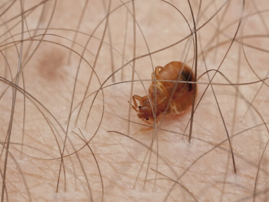 Can Bed Bugs Live In Your Hair? How To Get Them Out
